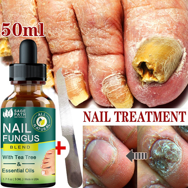 Best price for 2021 EXTRA STRONG Nail Fungus Treatment, Best Nail ...