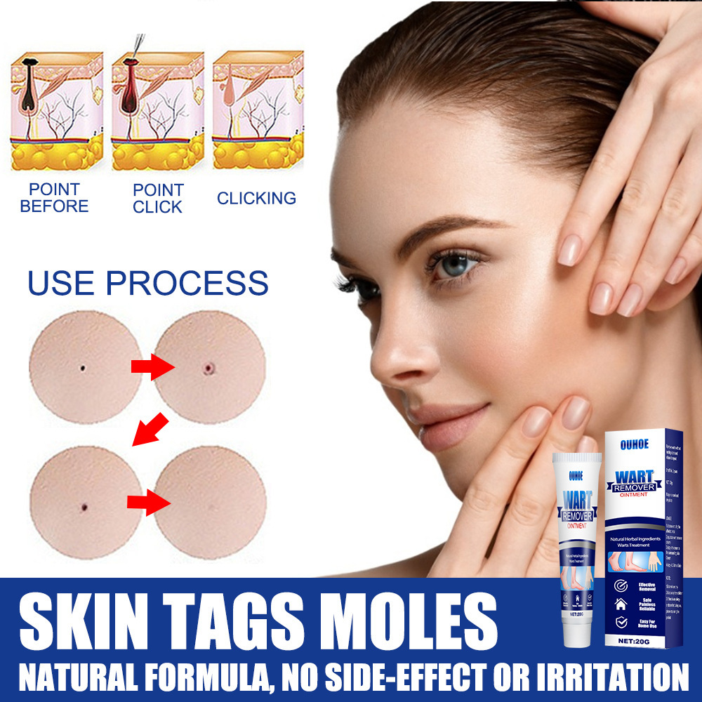 Best price for Skin Tag Remover Ointment Against Mole & Genital Wart ...