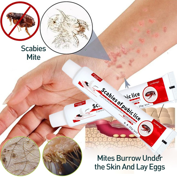 Exclusive discounts for Anti-itching Ointment Head Lice Mites Removal ...
